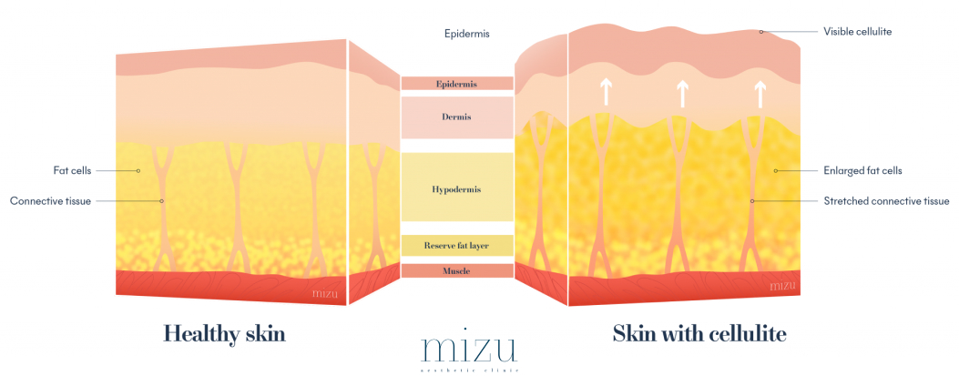 ONDA Coolwaves™ Singapore | Body and Fat Treatment